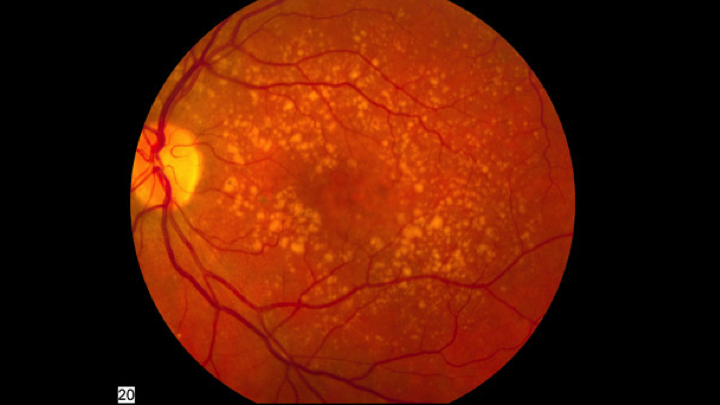 Implantation Of Multifocal Lens For Age-Related Macular Degeneration In ...