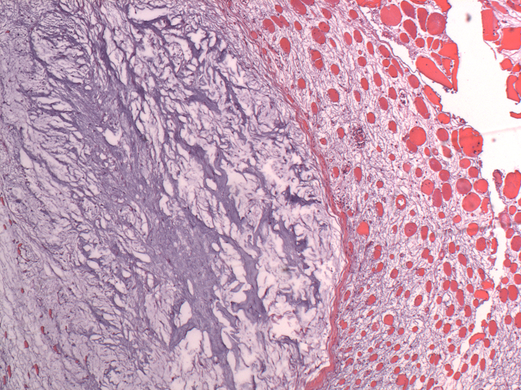 Intramuscular Myxoma Incidental Intercostal Intramuscular Myxoma With