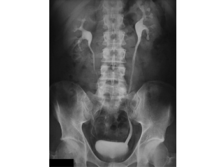 Intravenous Pyelogram