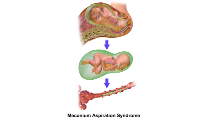 Meconium Aspiration Syndrome