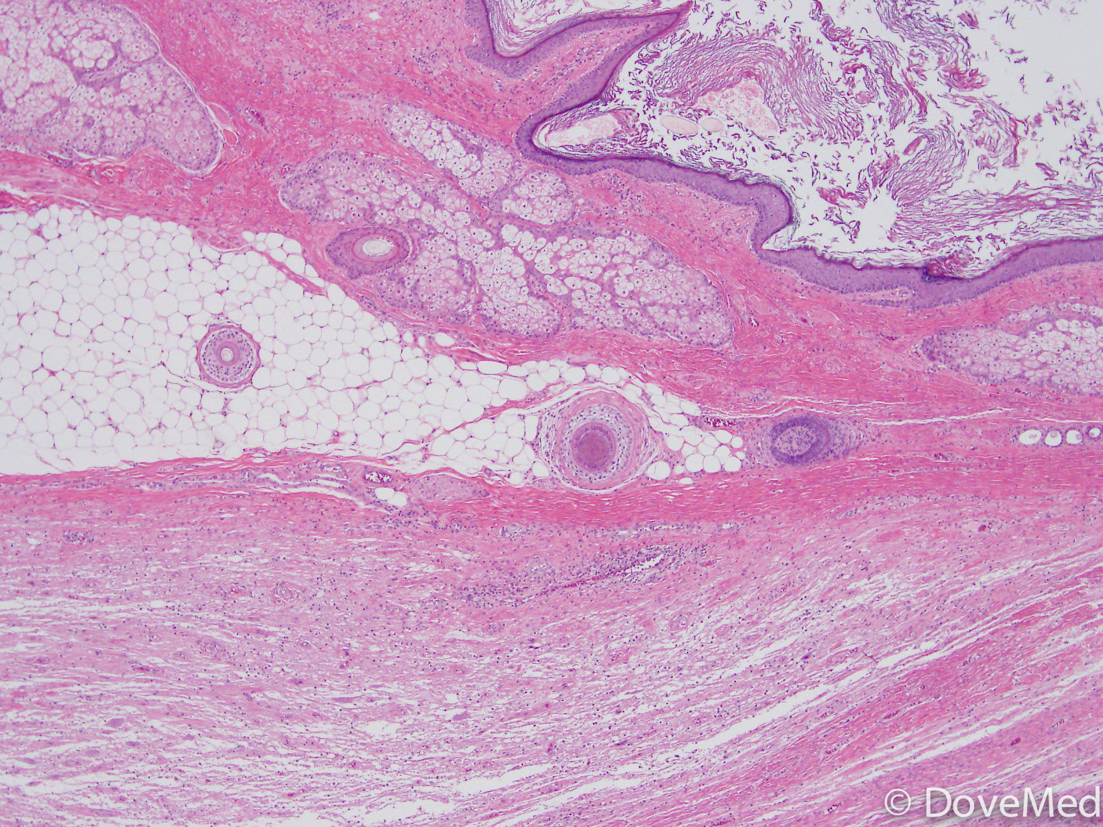 Ovarian Tumor Removal