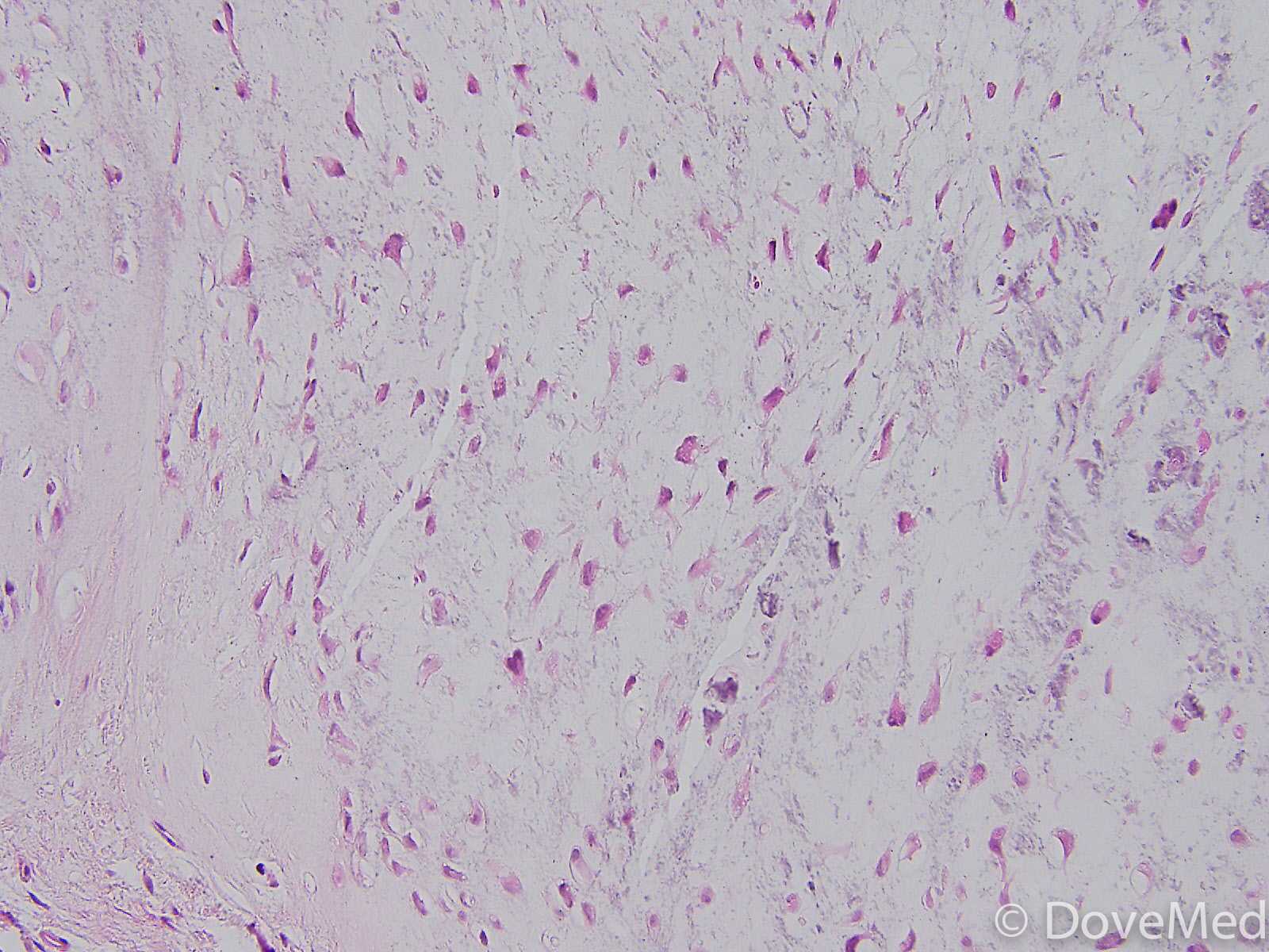Soft Tissue Chondroma