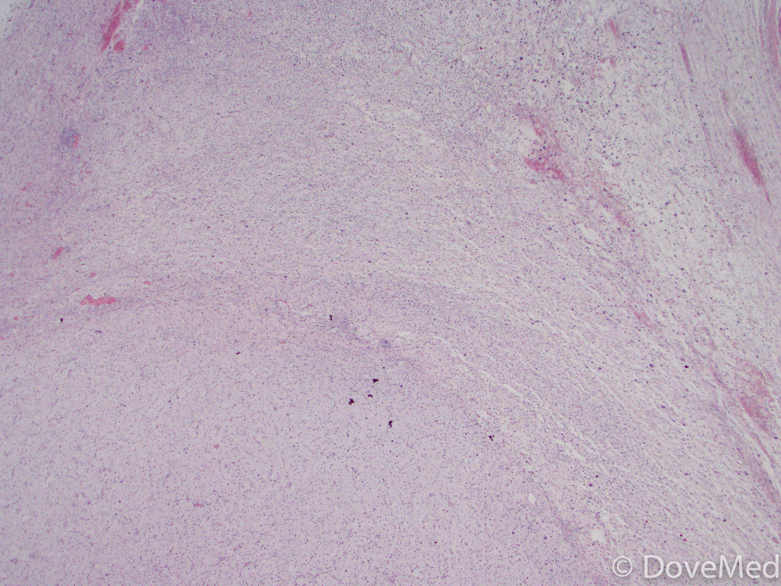 Myxofibrosarcoma