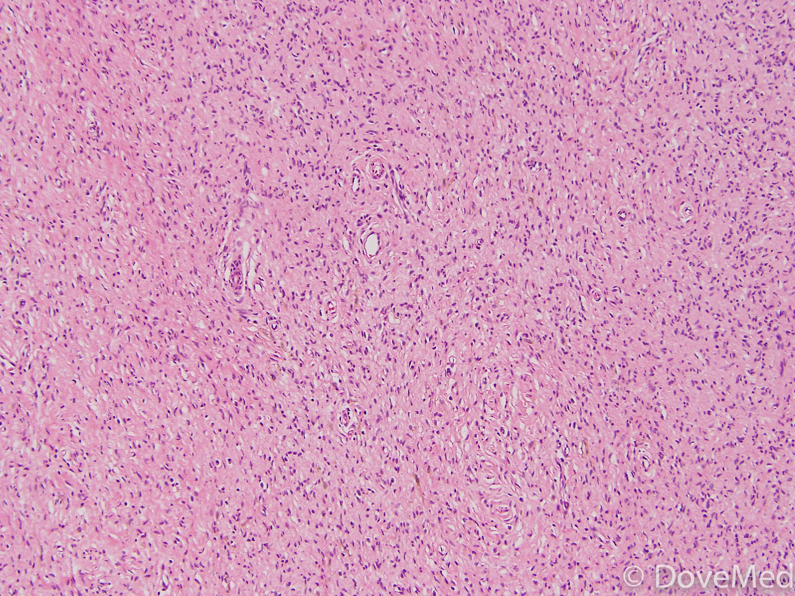 Diffuse Cutaneous Neurofibroma