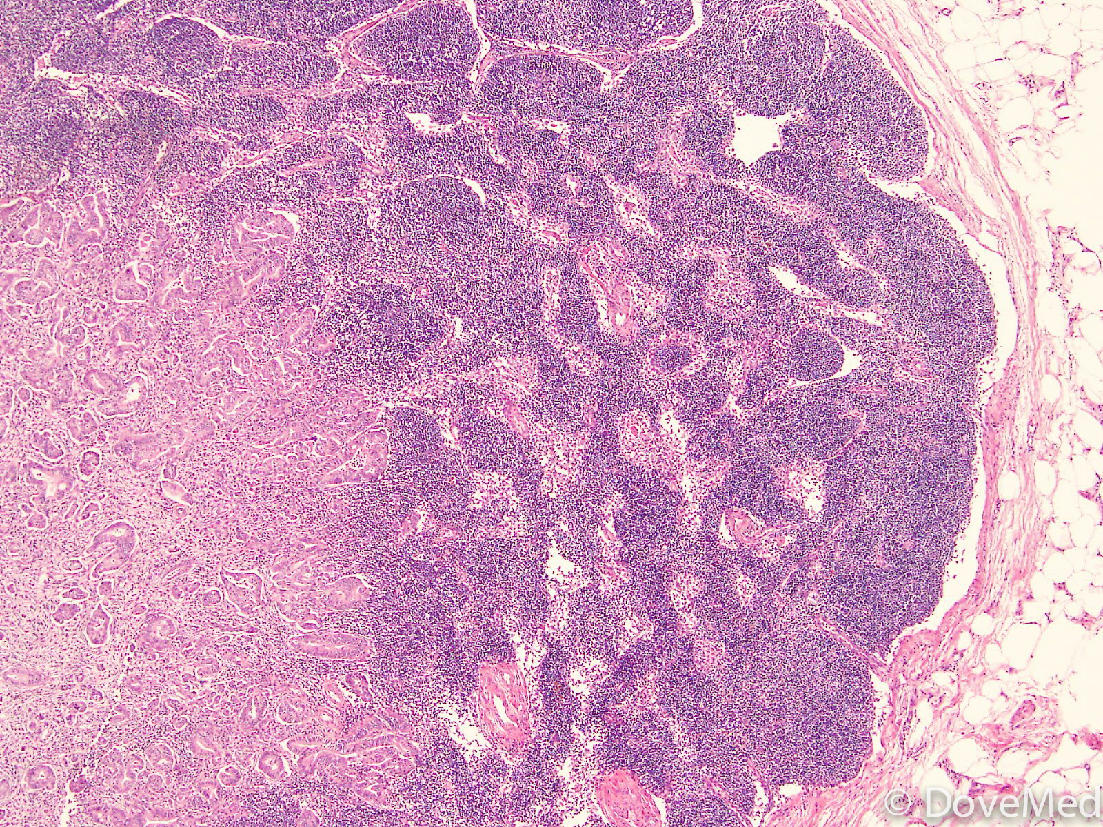 Sentinel Node Biopsy