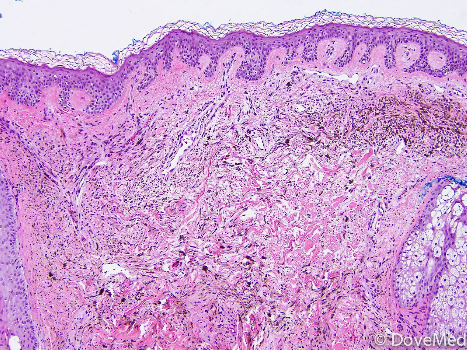 Blue Nevus Histology