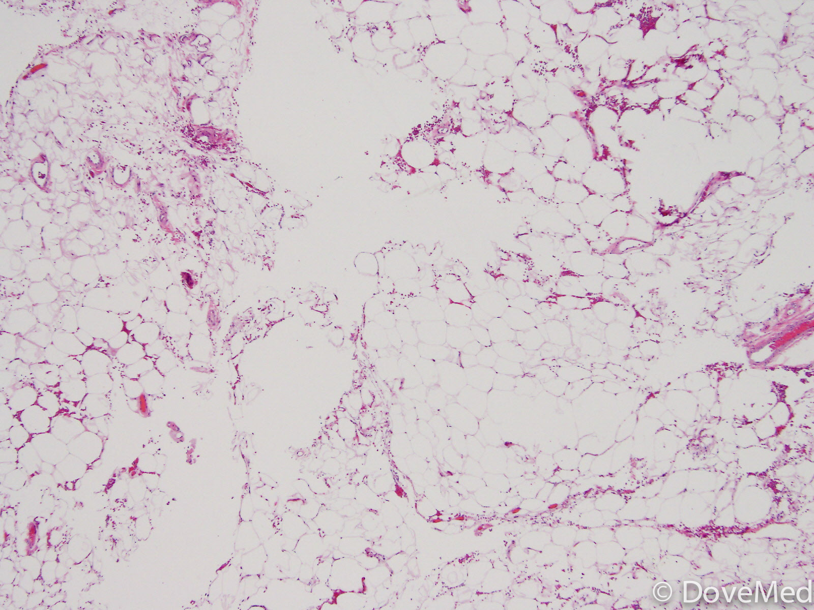 Lipoma of Small Intestine