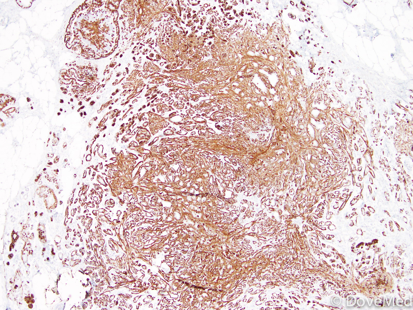 Sclerosing Adenosis of Breast