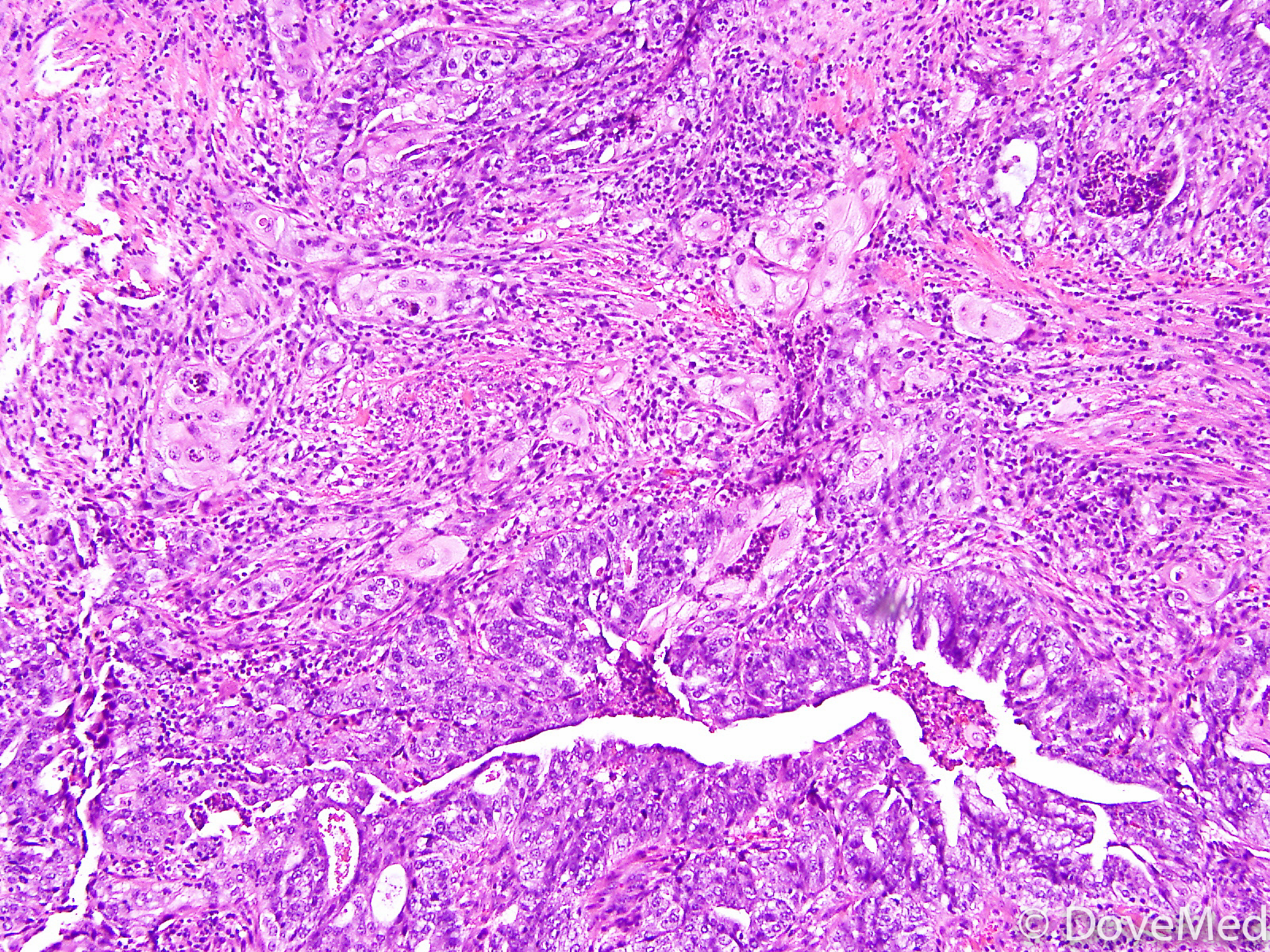 Adenosquamous Carcinoma Of Uterine Cervix Adenosquamous Carcinoma Of Uterine Cervix