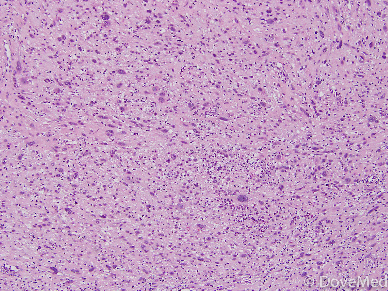 Synovial Sarcoma of Heart