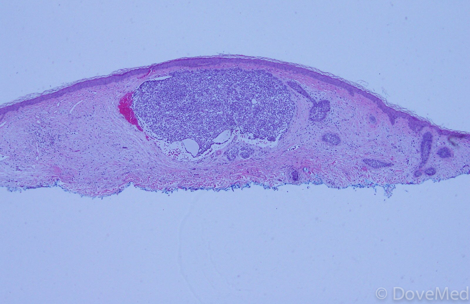 Nodular Basal Cell Carcinoma of Skin