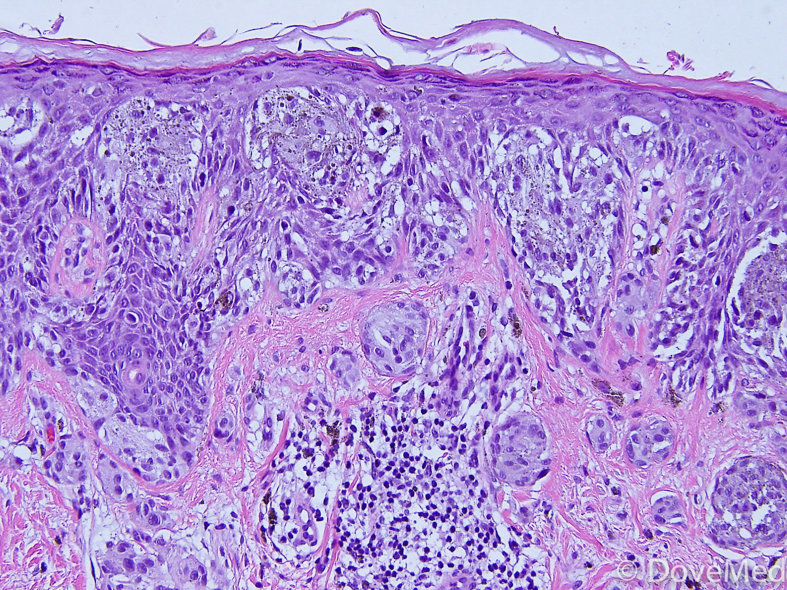 Melanoma of Nail Unit