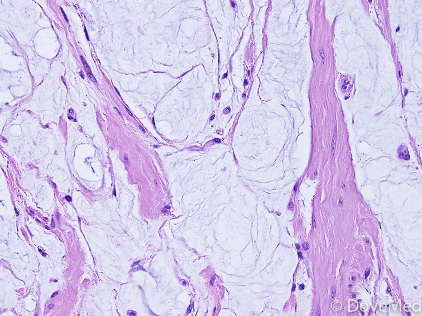 Juxta-Articular Myxoma