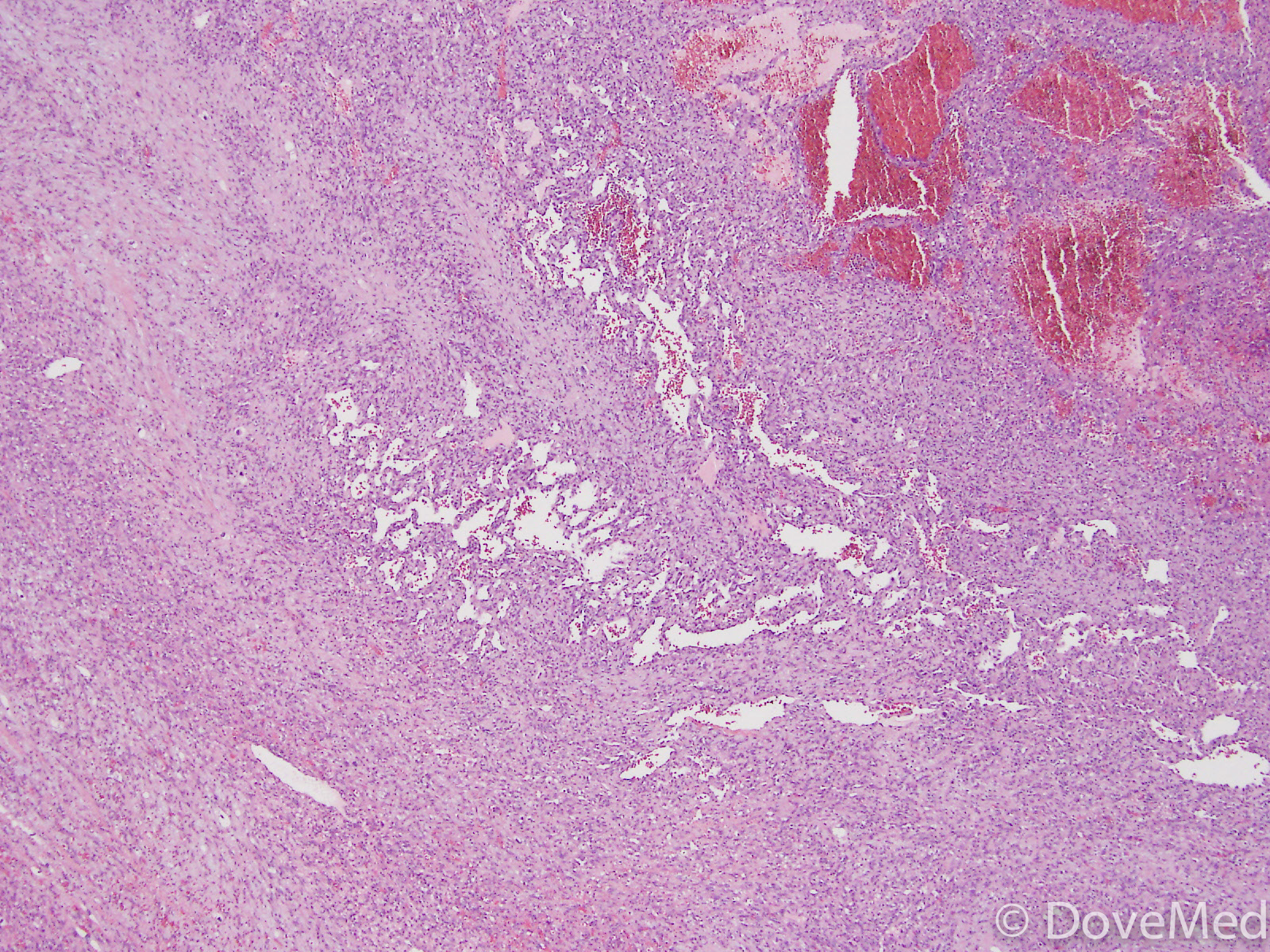 Angiosarcoma of Salivary Gland