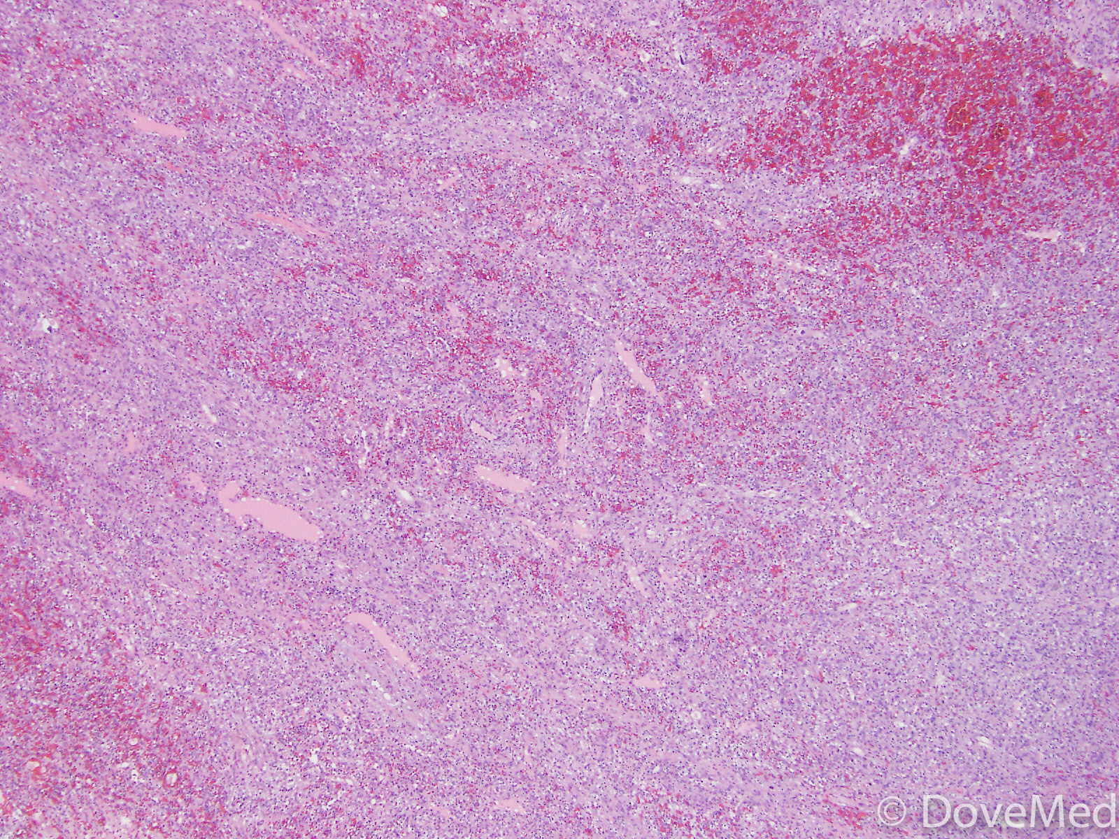Angiosarcoma of Skin