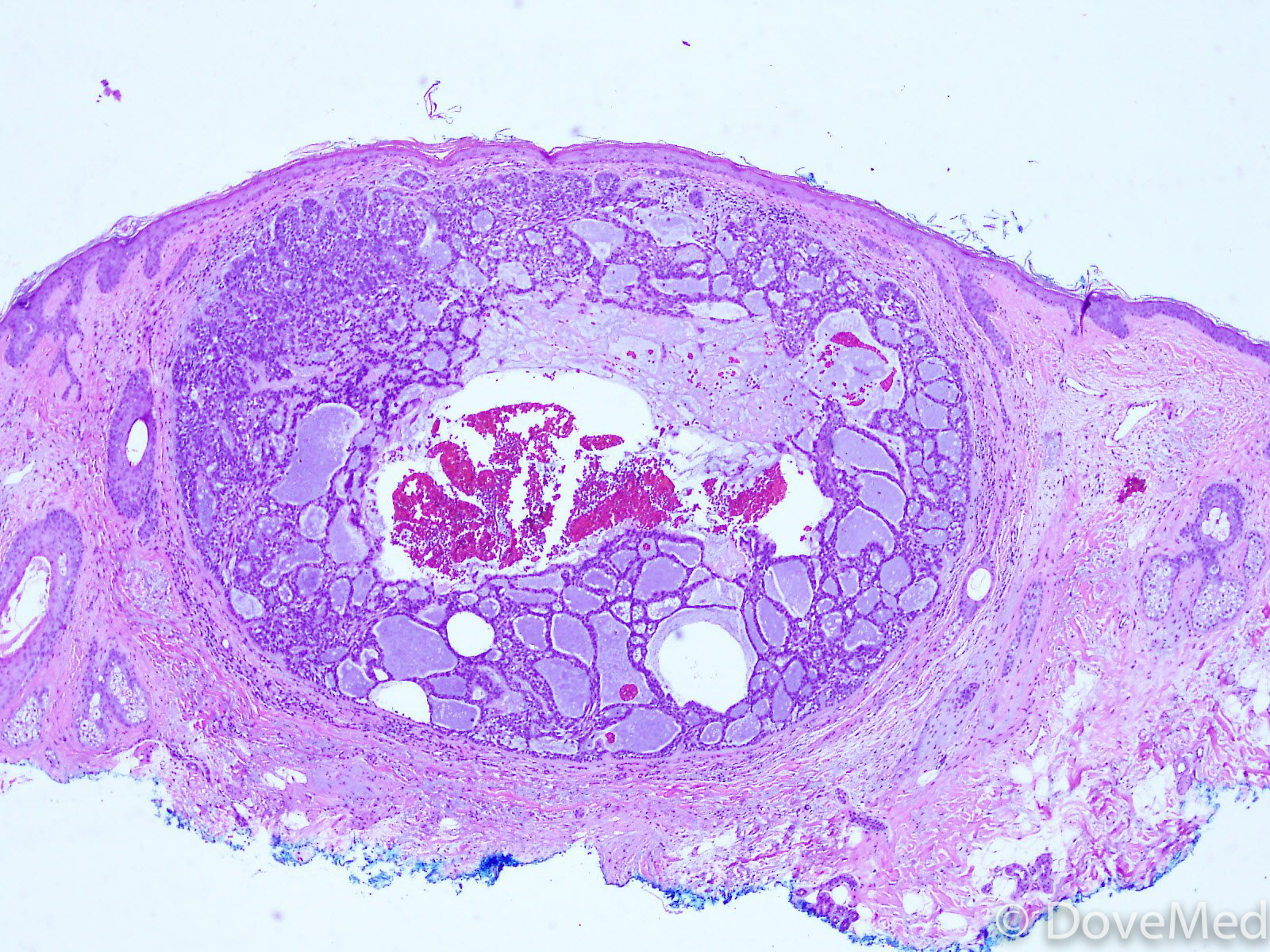 FDA Releases New Drug Aimed To Treat Basal Cell Carcinoma