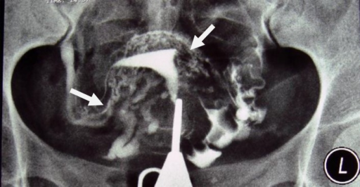 Hysterosalpingography