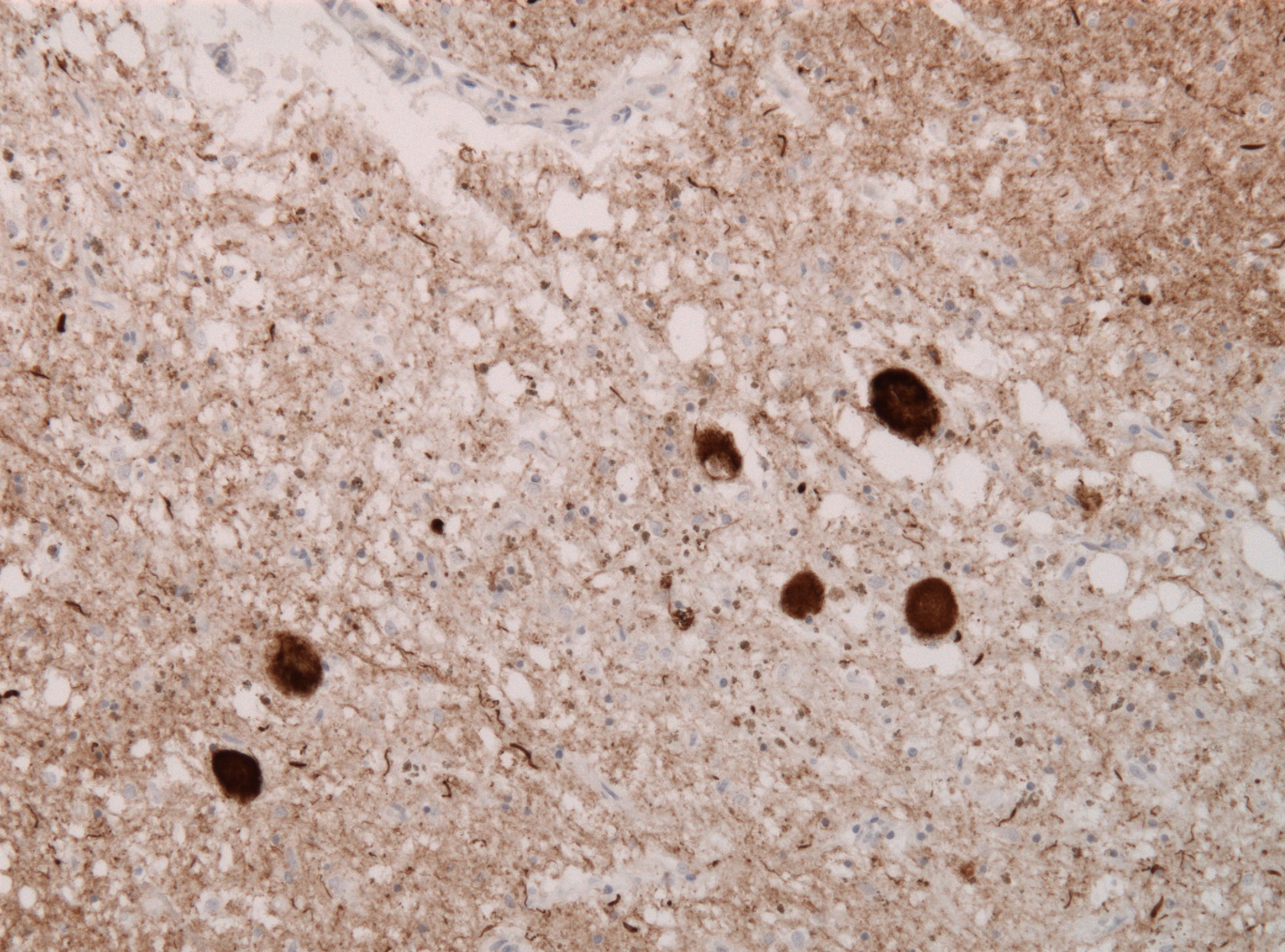 Progressive Supranuclear Palsy