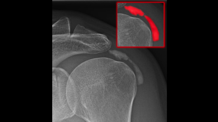 Bursitis of Shoulder