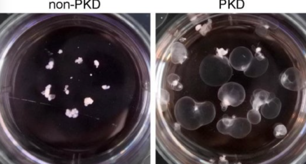 Mini-Kidneys Grown In Lab Reveal Renal Disease Secrets