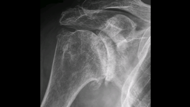 Osteoarthritis of Shoulder