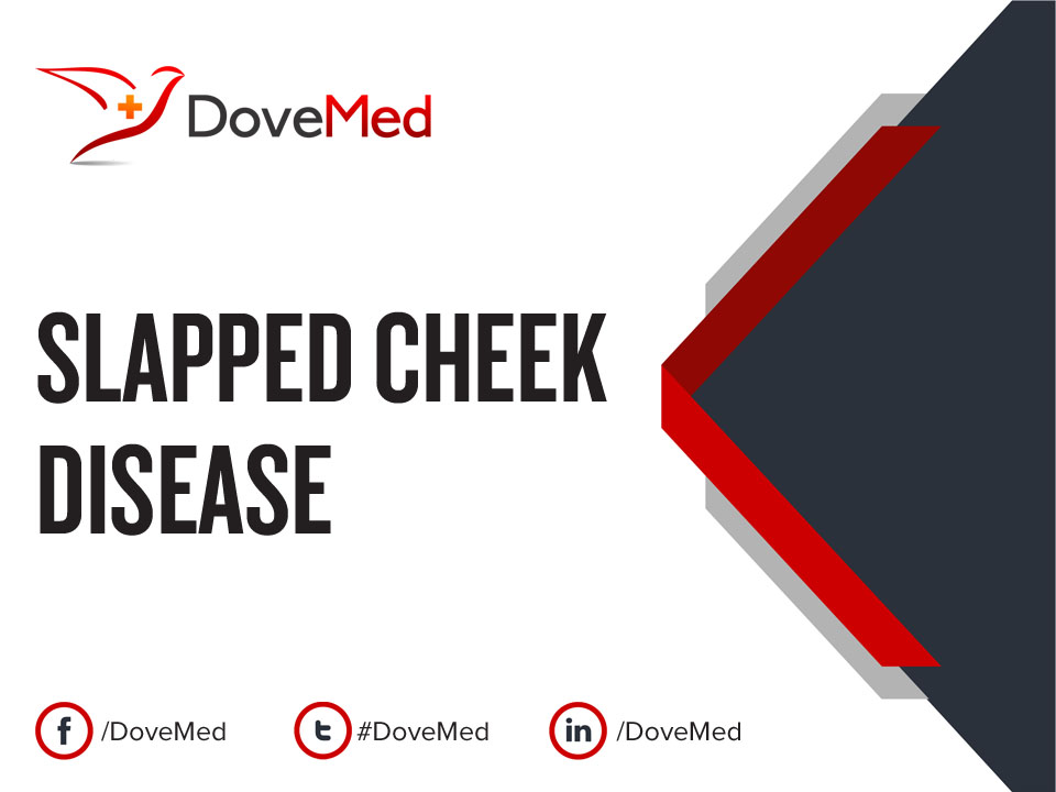 Slapped Cheek Disease