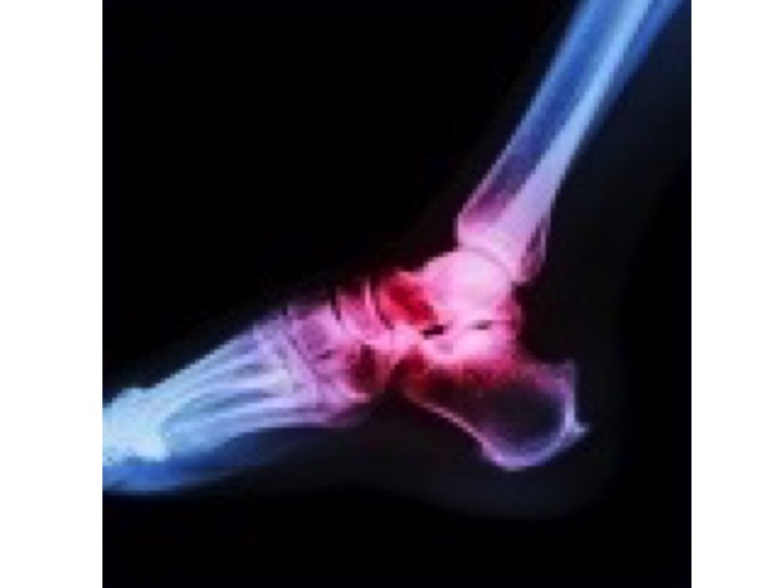 Arthritis of the Ankle