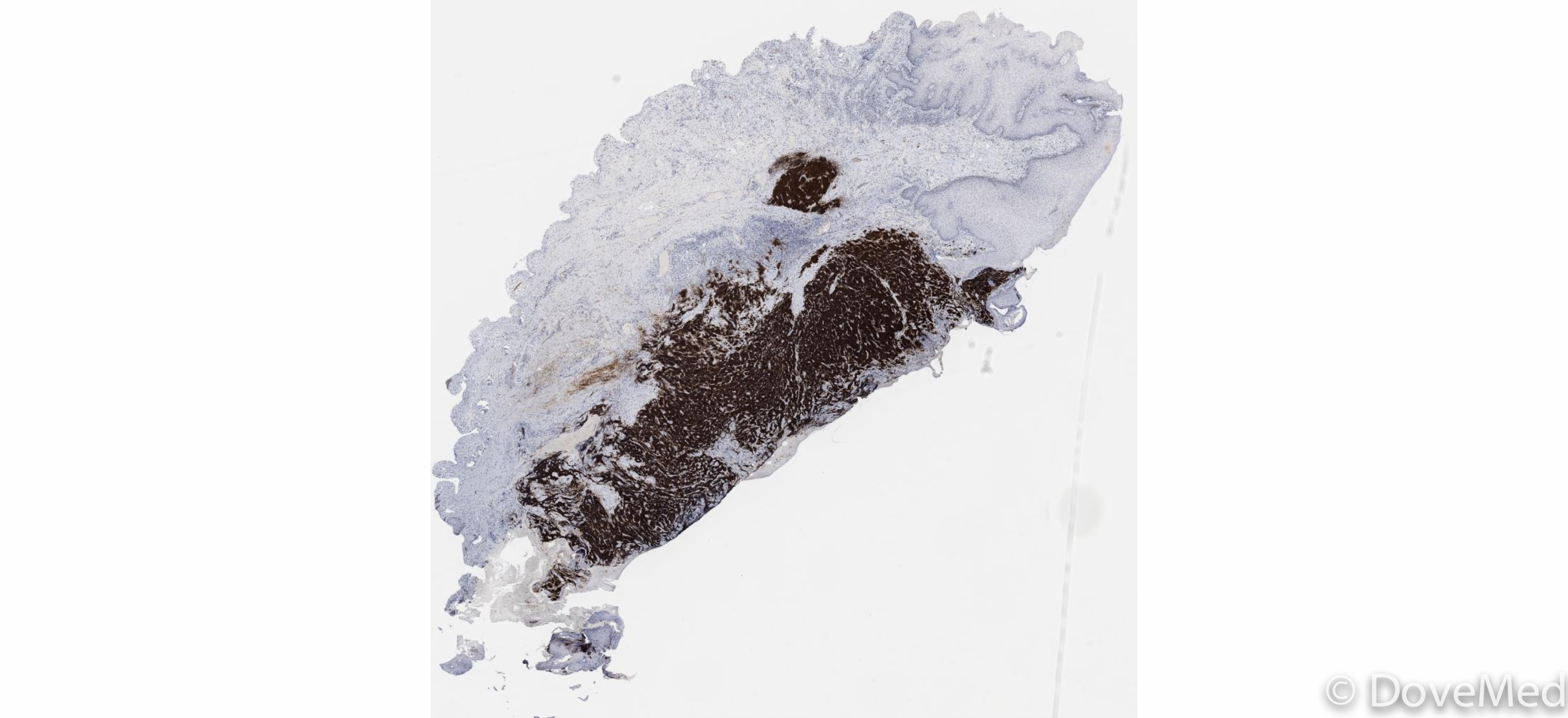 Small Cell Neuroendocrine Carcinoma of the Urinary Bladder Small Cell Neuroendocrine Carcinoma of the Urinary Bladder