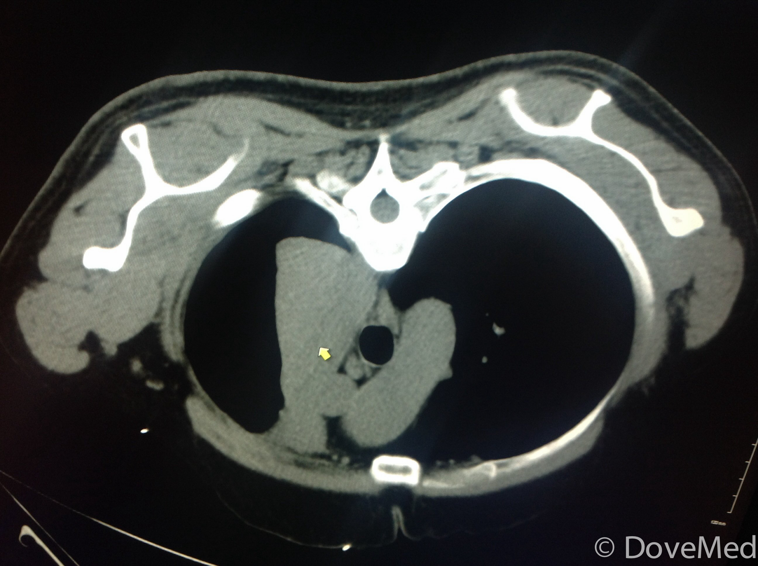 Squamous Cell Carcinoma of Lung