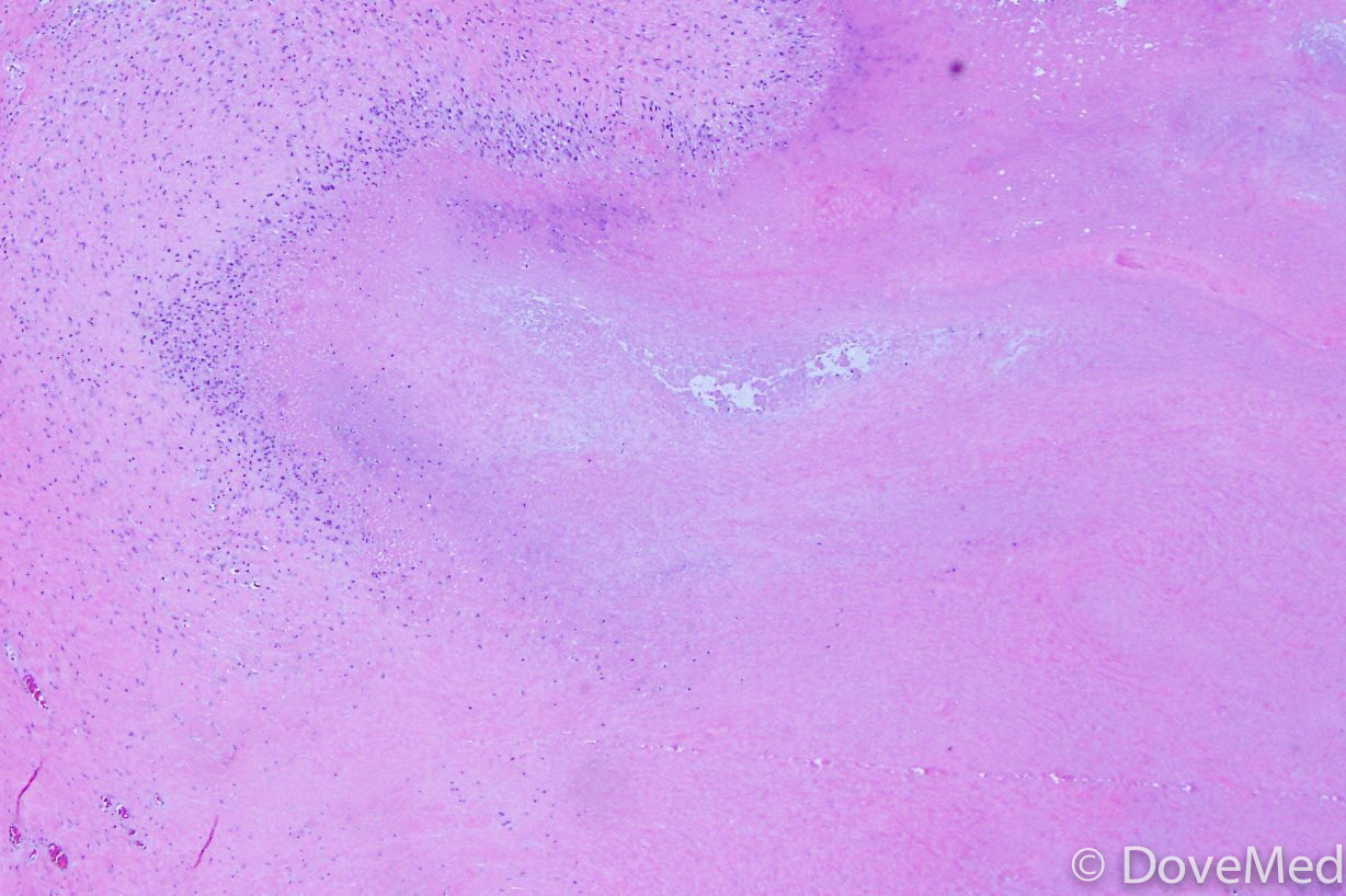 Granulomatosis with Polyangiitis (formerly Wegener Granulomatosis)