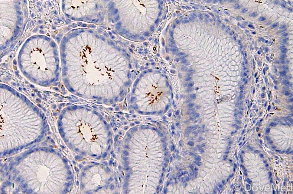 Autoimmune Gastritis