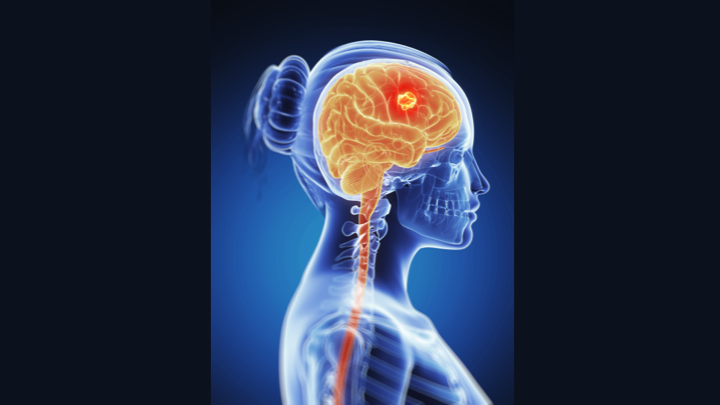 Compound Shown To Reduce Brain Damage Caused By Anesthesia In Early Study